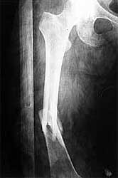 Síndrome de embolia grasa. A propósito de un caso