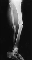 Síndrome de embolia grasa. A propósito de un caso