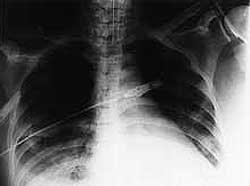 Síndrome de embolia grasa. A propósito de un caso