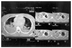 Síndrome de dificultad respiratoria del adulto. Tratamiento y ...