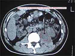 Absceso del Psoas, Causa Infrecuente de Dolor Lumbar